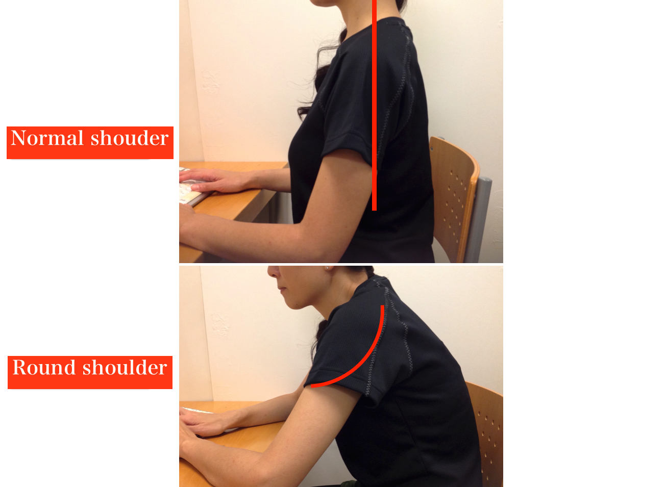 [Case report] Shoulder-joint ｜ KIZUカイロプラクティック整体本院